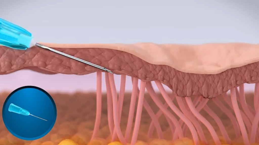 Subcision Sydney Treatment | Contour Cosmetic Clinics