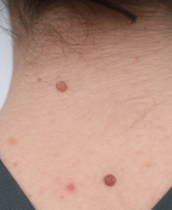 Mole Removal Sydney | Remove Moles with No Scar | Cosmetic Doctors