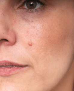 Mole Removal Sydney | Contour Clinics