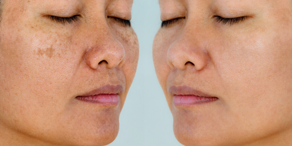 Cosmelan Peel Before & After – Contour Clinics Results