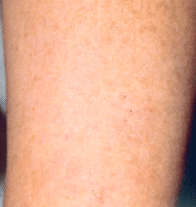 Pigmentation Removal Sydney | Contour Laser Skin Clinics