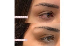 Before and After Fox Eye Thread Lift | Contour Clinics