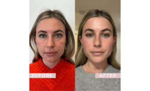 Thread Lift Before and After Photos & Results | Contour Clinics