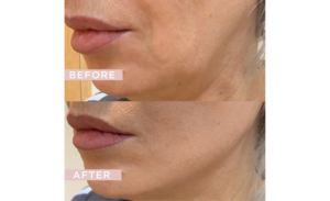 Thread Lift Before and After Photos & Results | Contour Clinics