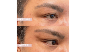 Before and After Fox Eye Thread Lift | Contour Clinics