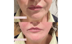 Thread Lift Before and After Photos & Results | Contour Clinics