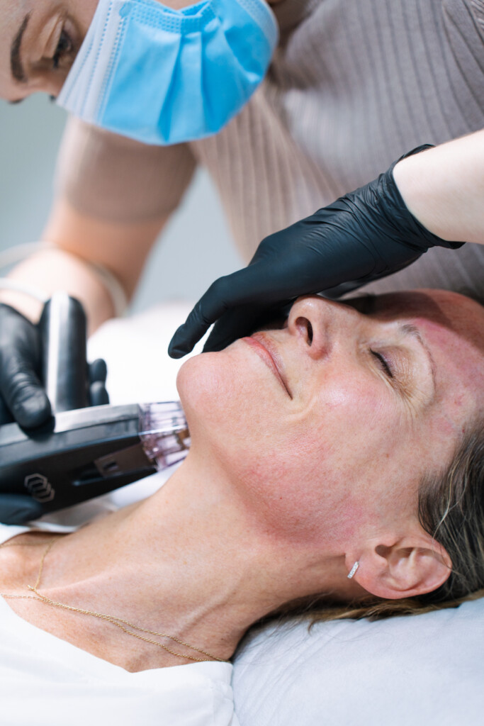 Morpheus 8 Laser Sydney | RF Micro Needling | Contour Clinics