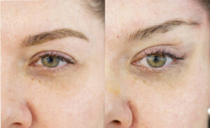 Before and After Fox Eye Thread Lift | Contour Clinics