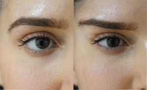 Before and After Fox Eye Thread Lift | Contour Clinics