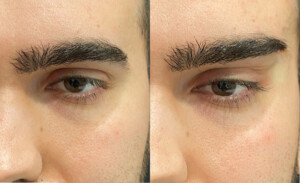 Before and After Fox Eye Thread Lift | Contour Clinics