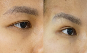 Before and After Fox Eye Thread Lift | Contour Clinics
