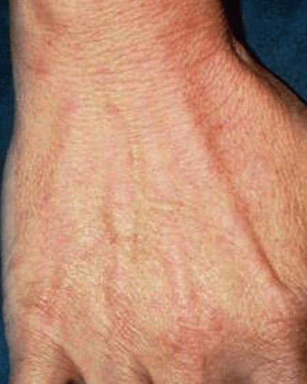 Laser Hand Skin Rejuvenation Treatment Sydney | Contour Clinics