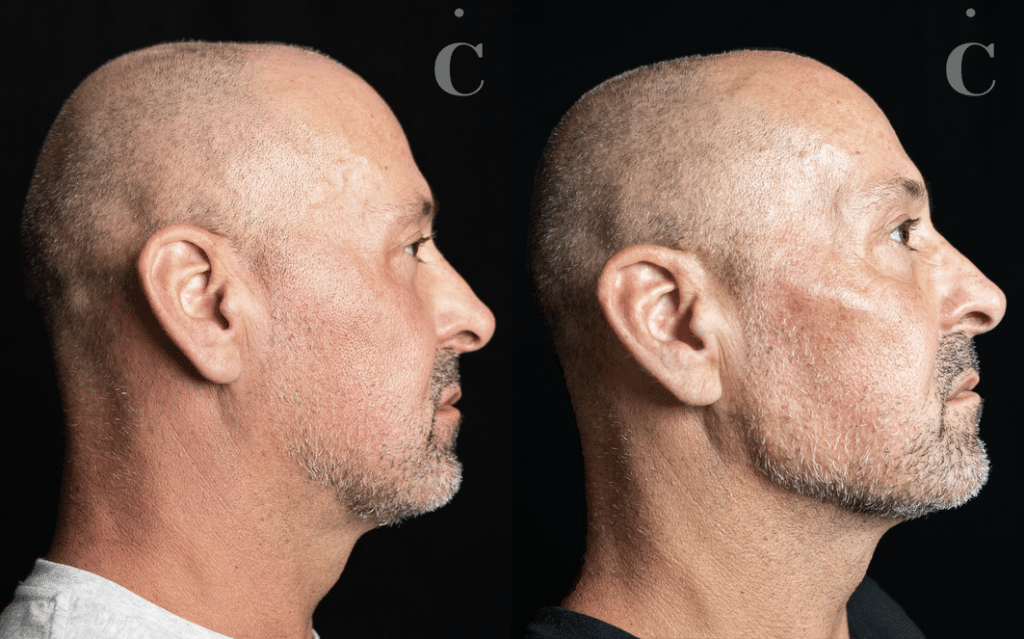 Masculinisation Filler Sydney | Fillers for Men | Contour Clinics