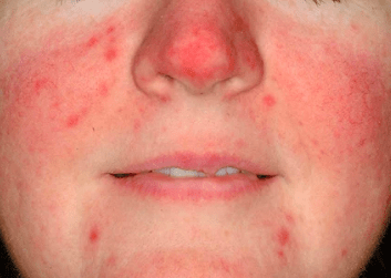 CO2 Laser - Fractional Laser Resurfacing Skin Treatments