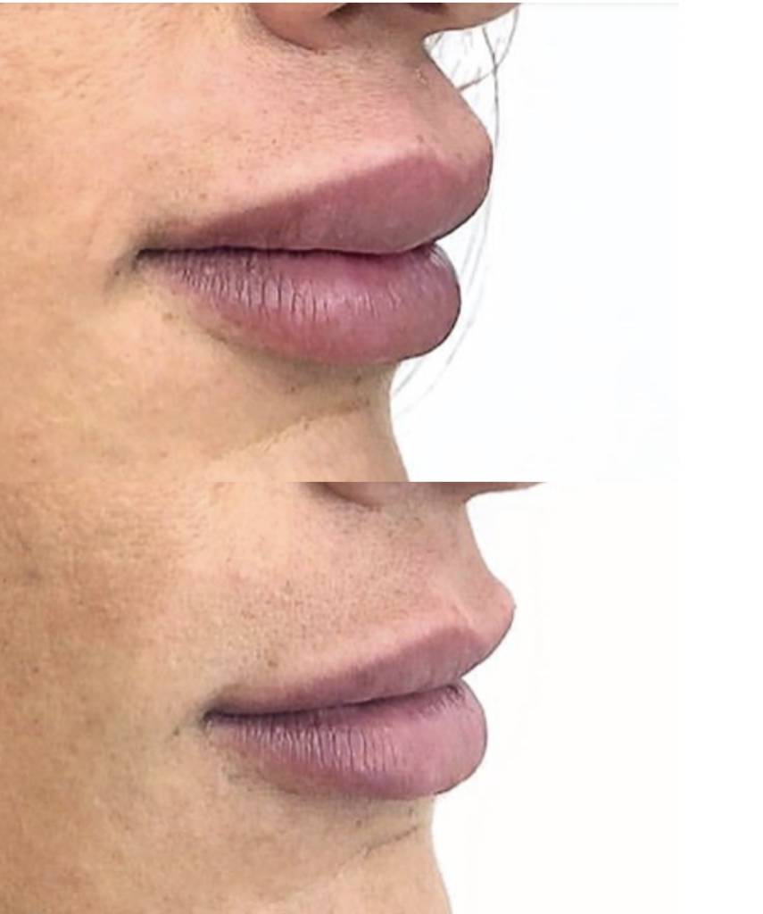 Hyalase | Filler Reversal & Correction | Contour Cosmetic Clinics