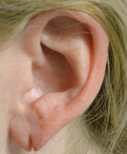 Earlobe Repair Brisbane | Stitching Treatment | Contour Clinics
