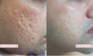 TCA Cross Treatment | Sydney & Brisbane | Treatment For Acne Scarring