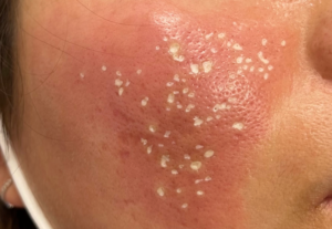 TCA Cross Treatment | Sydney & Brisbane | Treatment For Acne Scarring