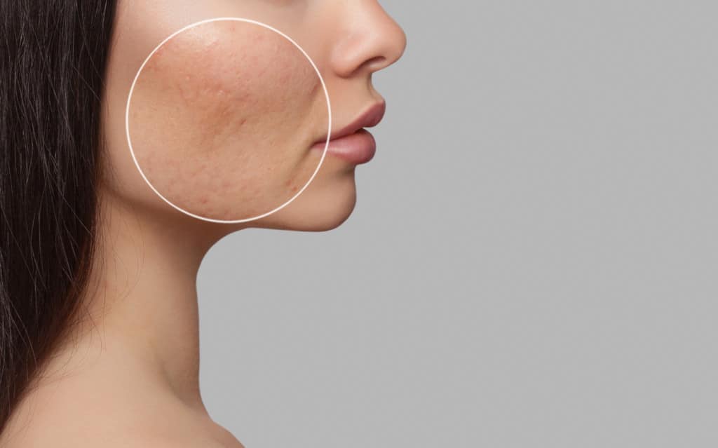TCA Cross Treatment | Sydney & Brisbane | Treatment For Acne Scarring
