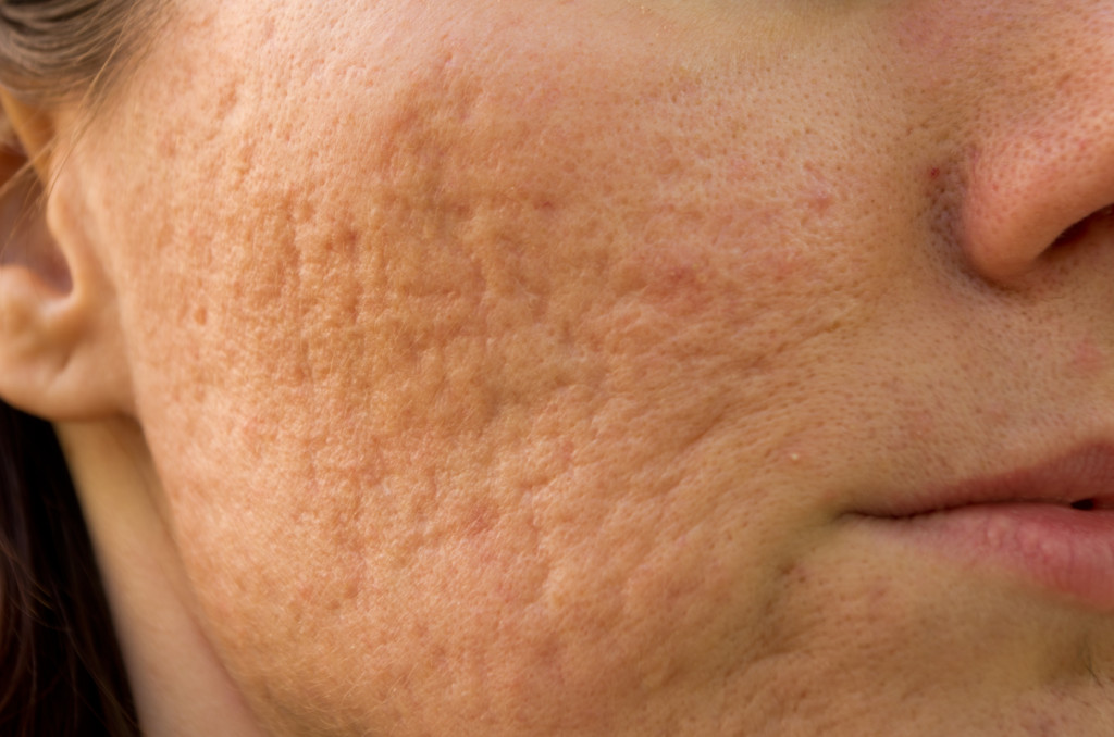 TCA Cross Treatment | Sydney & Brisbane | Treatment For Acne Scarring