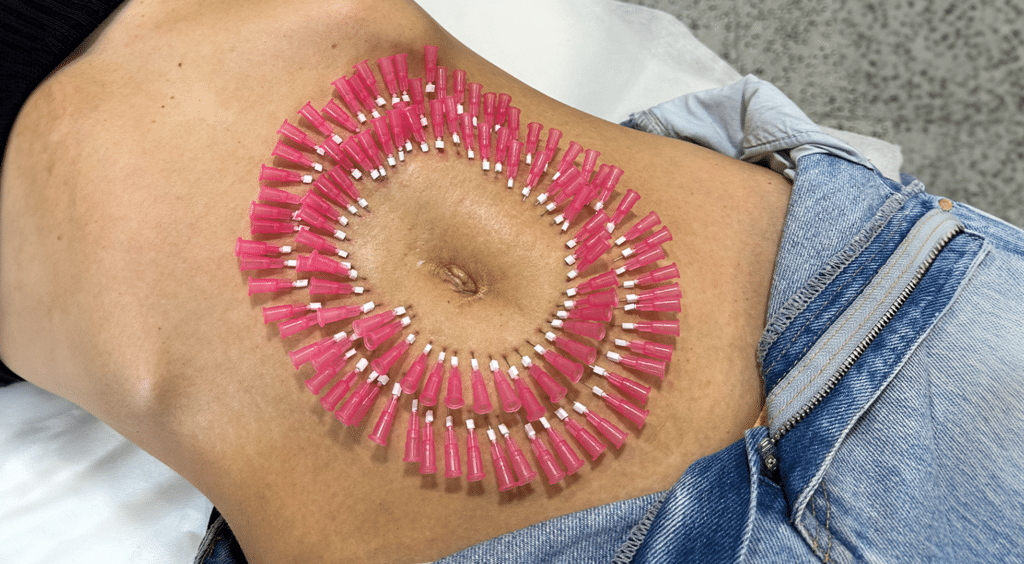 PDO Mono Threads | Thread Lift | Contour Clinics