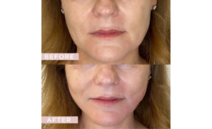 Thread Lift Before and After Photos & Results | Contour Clinics